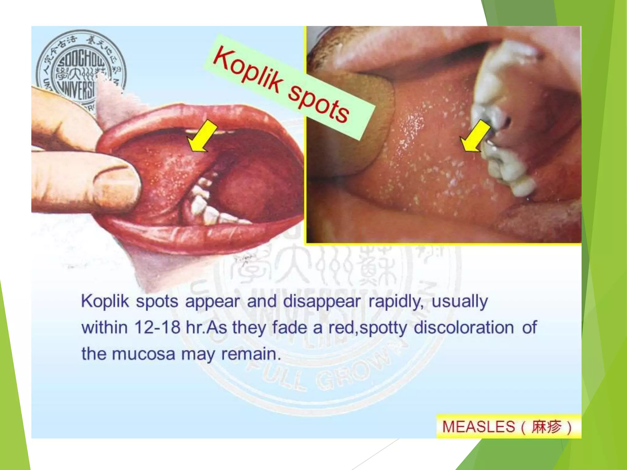 approach to child with fever and Rash | PPTX