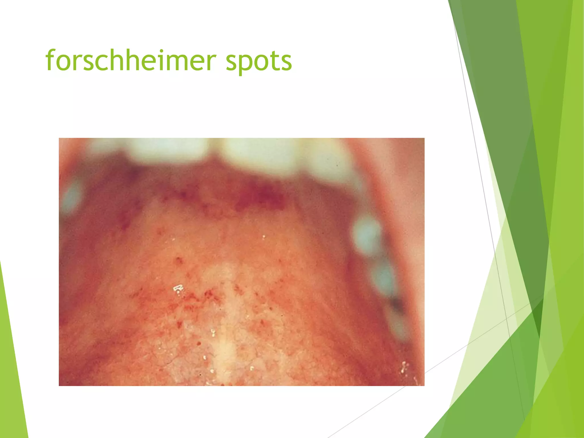 approach to child with fever and Rash | PPTX
