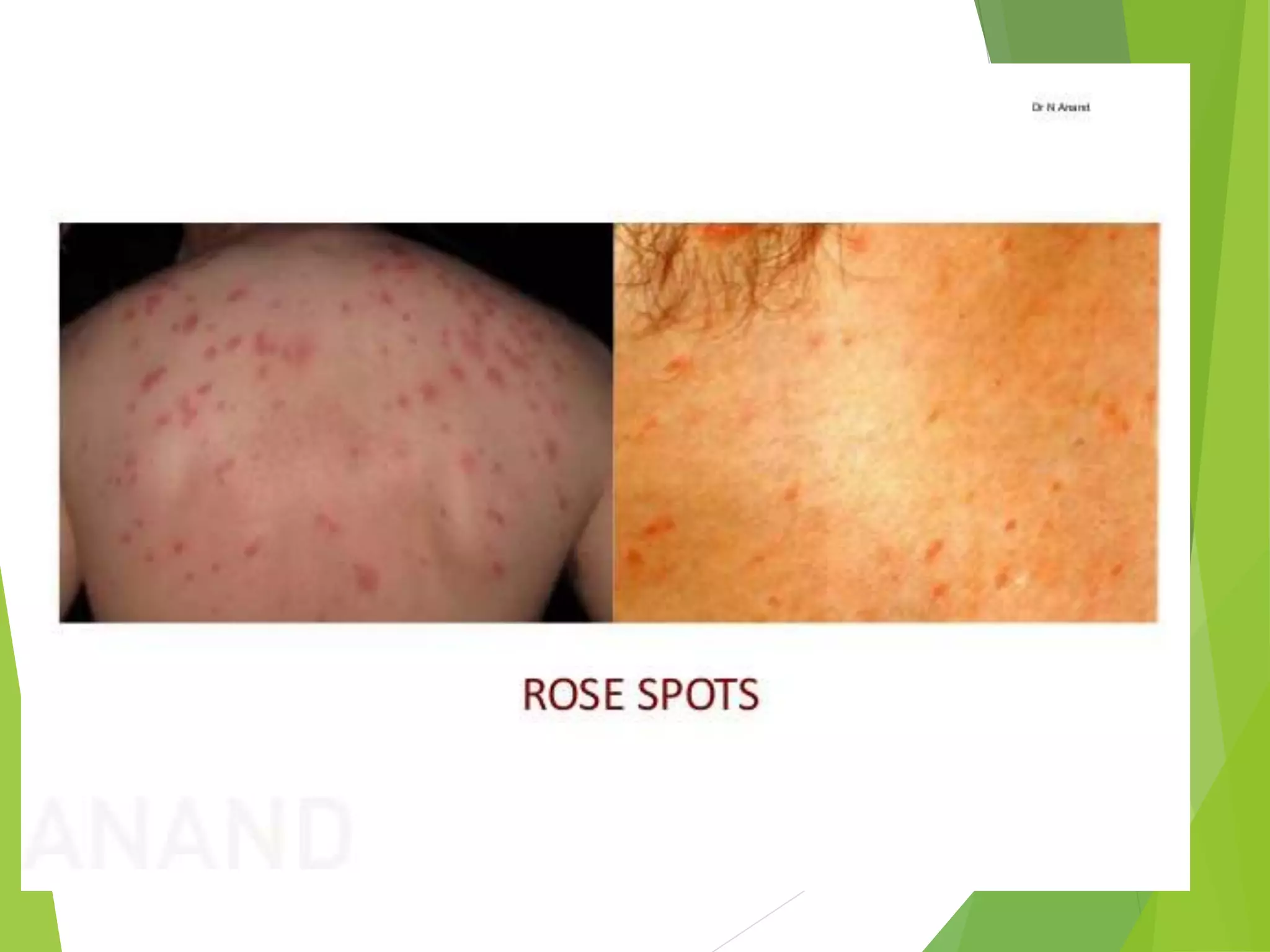 approach to child with fever and Rash | PPTX