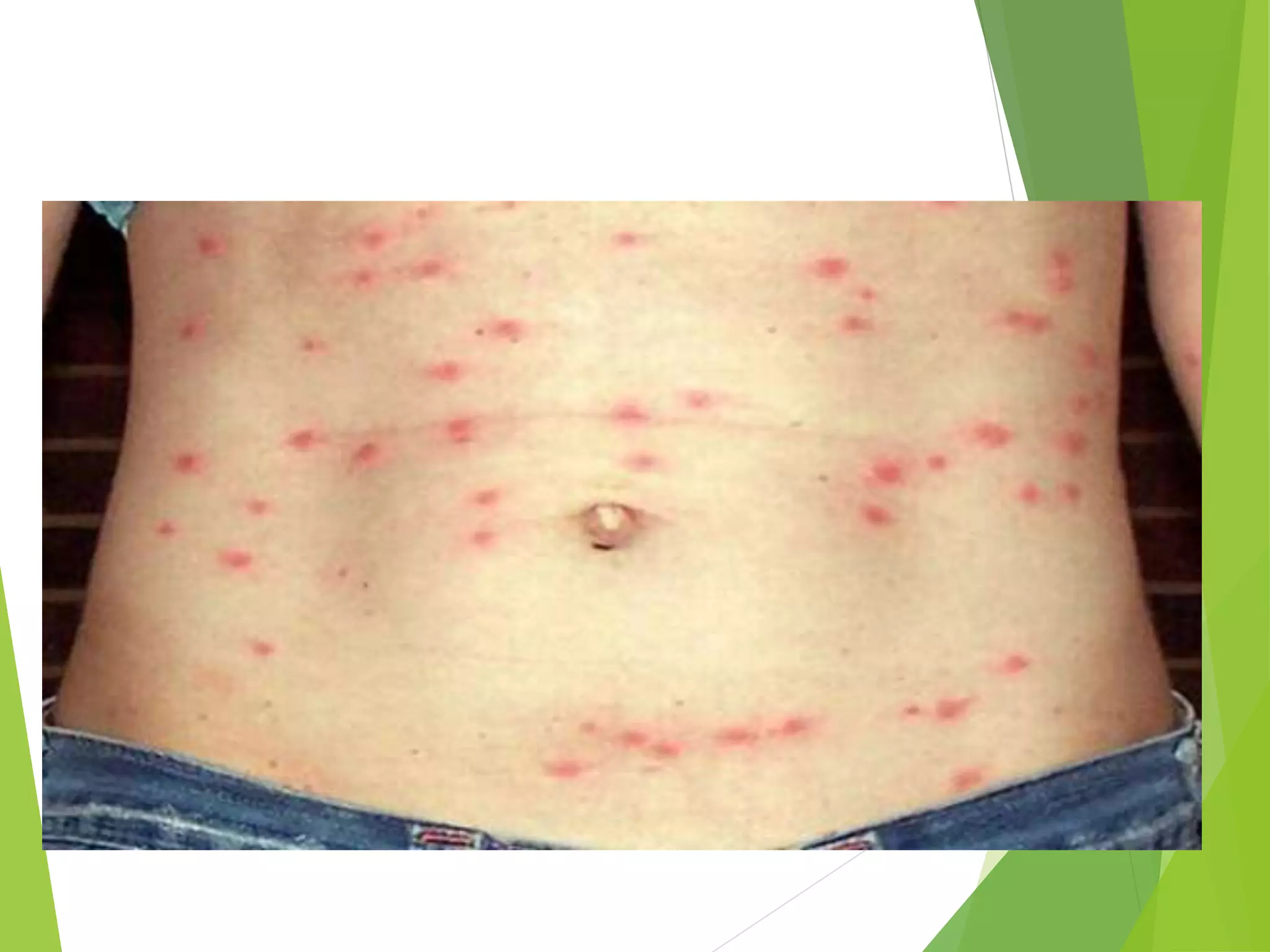 approach to child with fever and Rash | PPTX