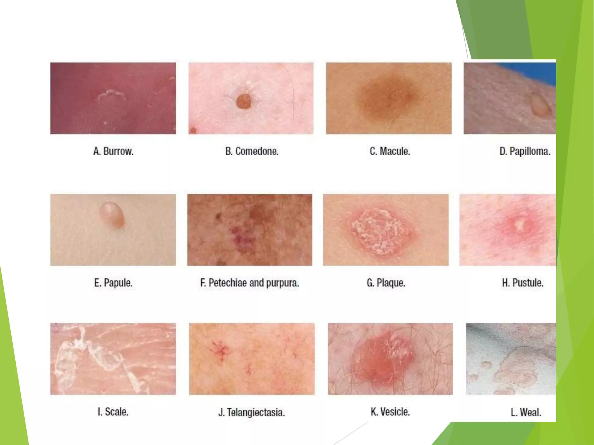 approach to child with fever and Rash | PPTX