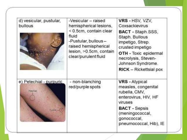 approach to child with fever and Rash | PPTX