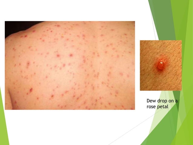 approach to child with fever and Rash | PPTX