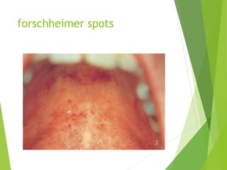 approach to child with fever and Rash | PPTX