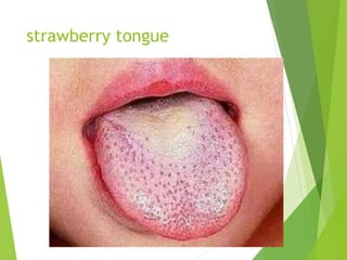 approach to child with fever and Rash | PPTX