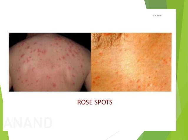 approach to child with fever and Rash | PPTX