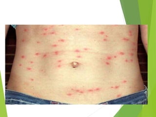 approach to child with fever and Rash | PPTX