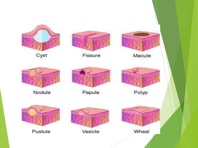 approach to child with fever and Rash | PPTX