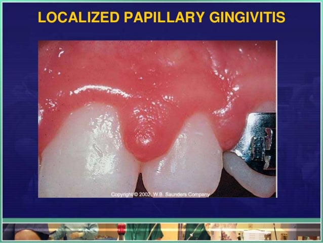 Gingivitis