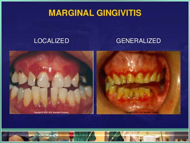 Gingivitis