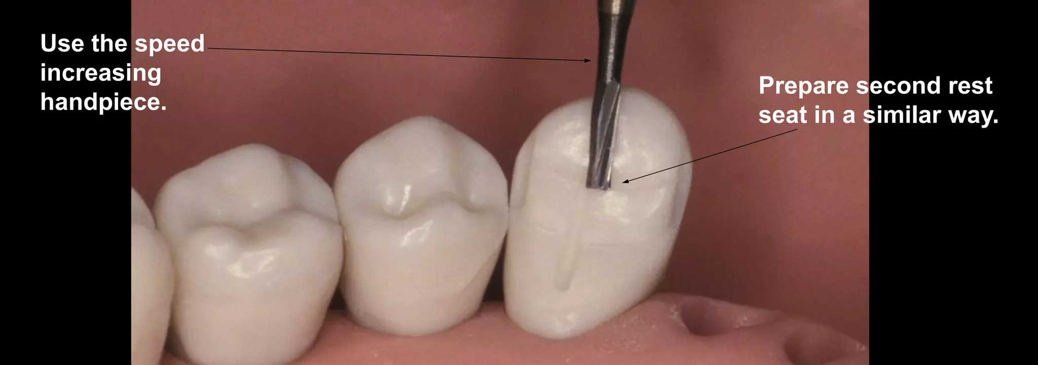 Tooth Preparation - Maryland preps | PDF