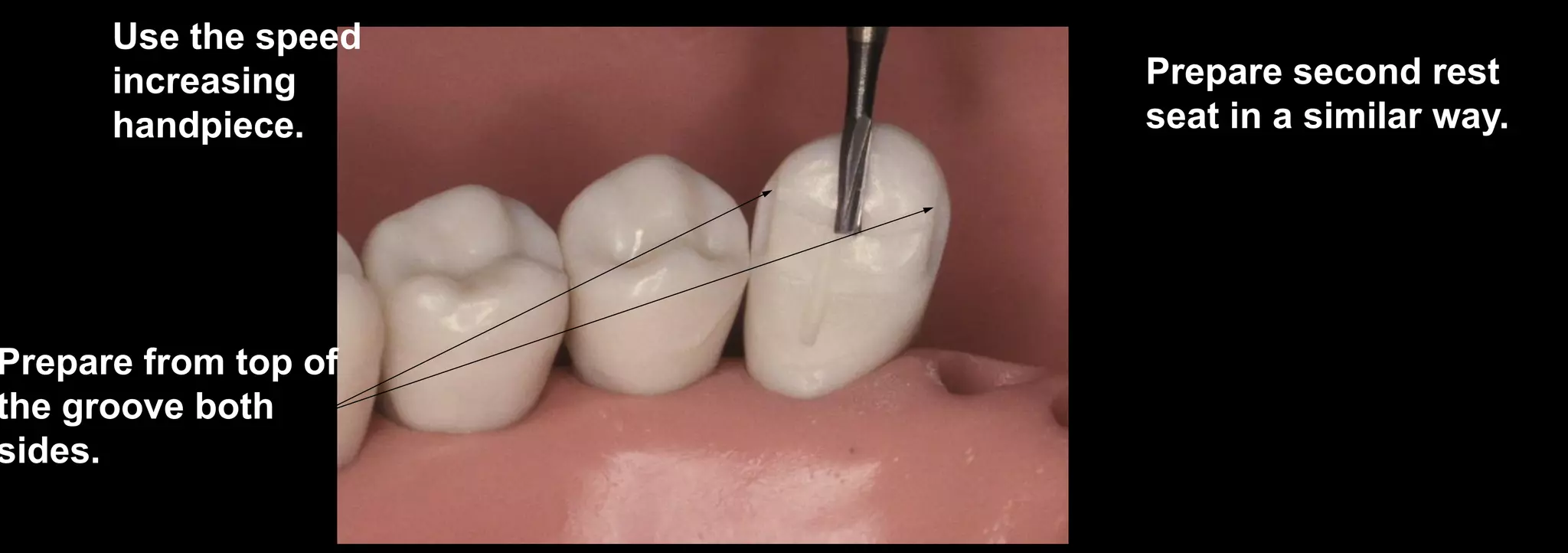 Tooth Preparation - Maryland preps | PDF