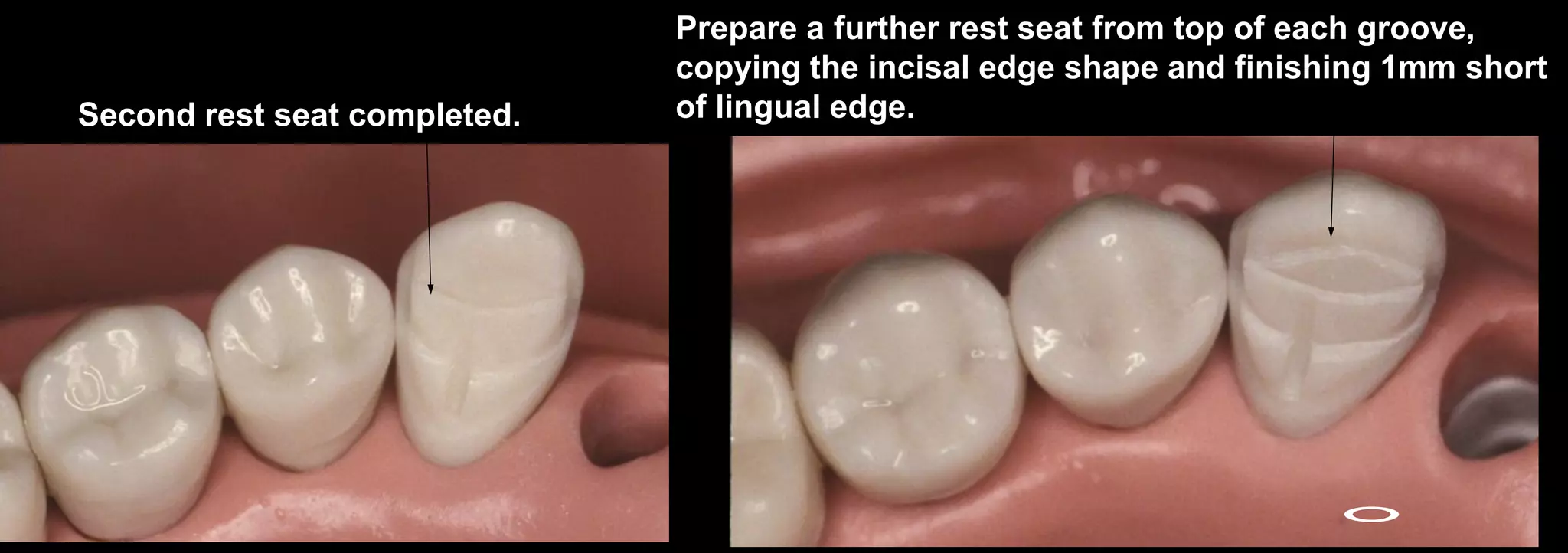 Tooth Preparation - Maryland preps | PDF