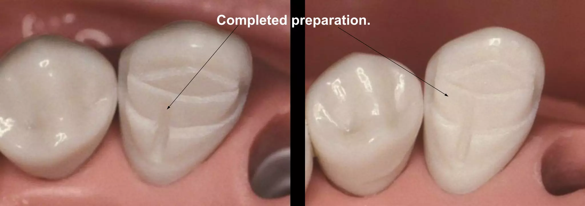 Tooth Preparation - Maryland preps | PDF