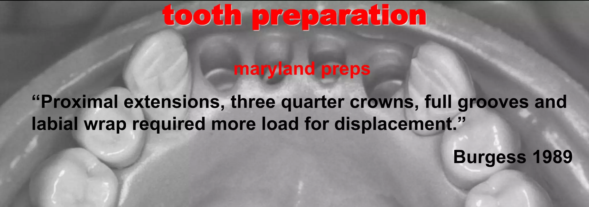 Tooth Preparation - Maryland preps | PDF