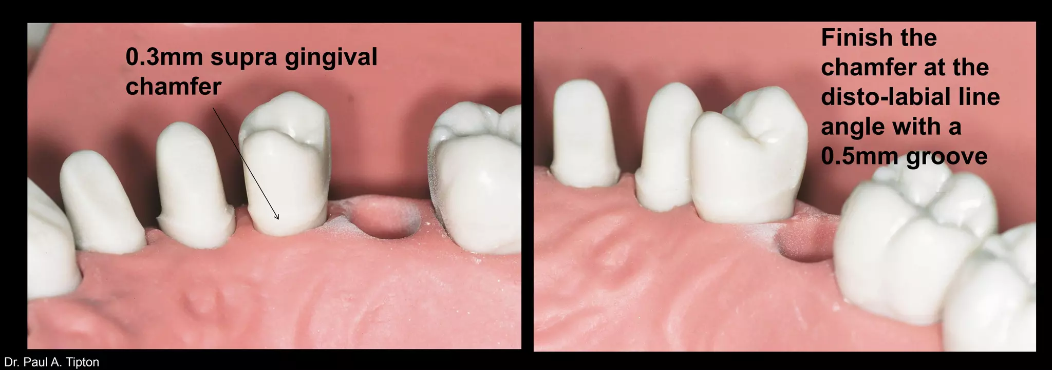 Tooth Preparation - Maryland preps | PDF