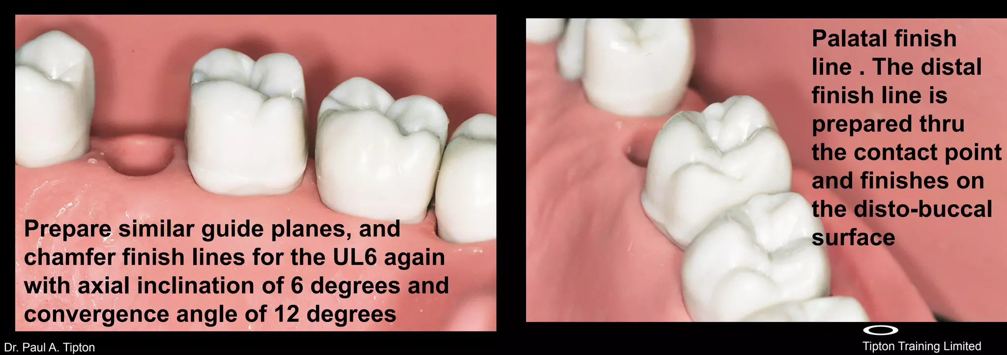 Tooth Preparation - Maryland preps | PDF