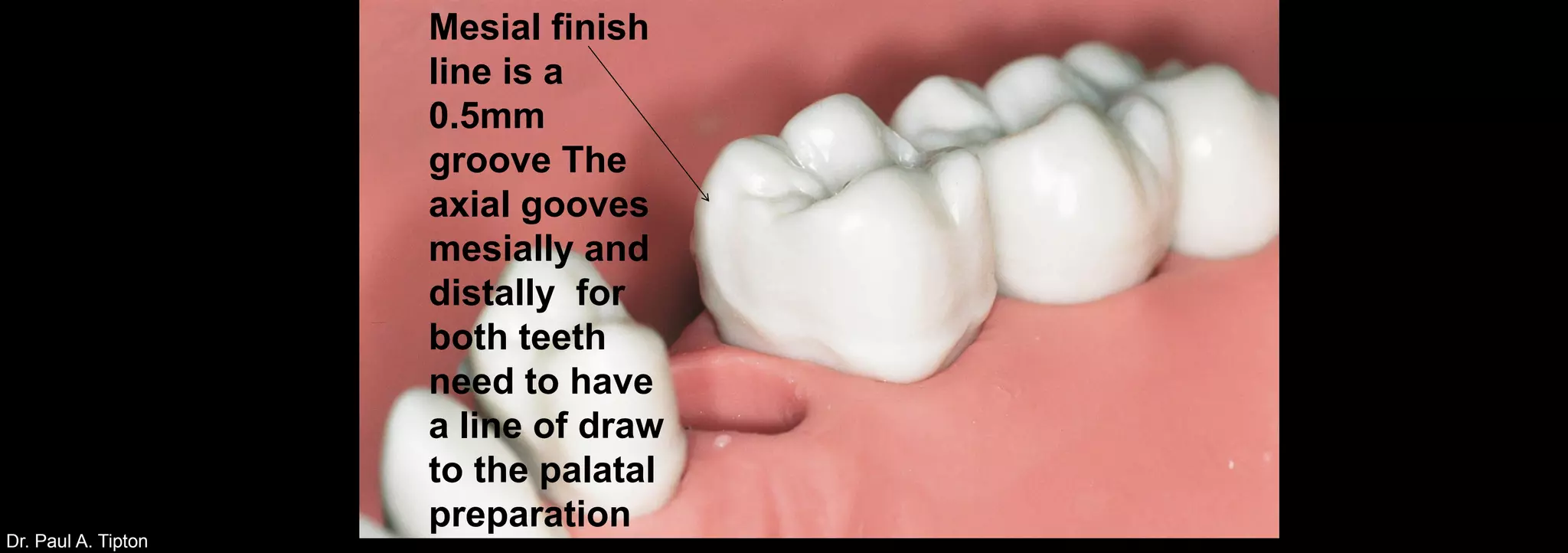 Tooth Preparation - Maryland preps | PDF