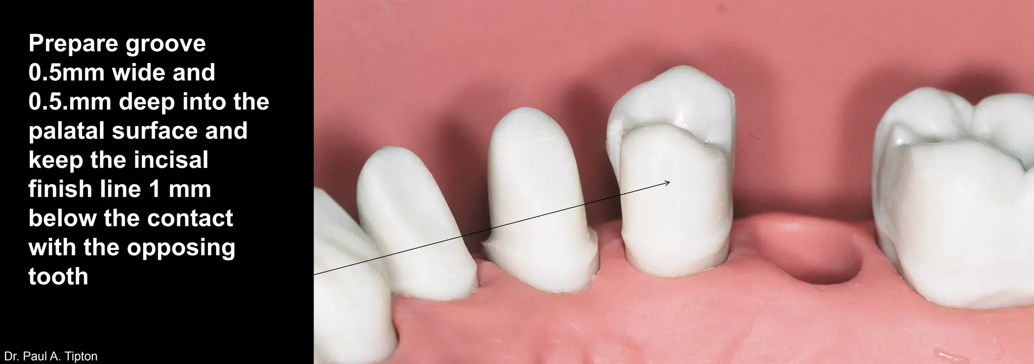 Tooth Preparation - Maryland preps | PDF