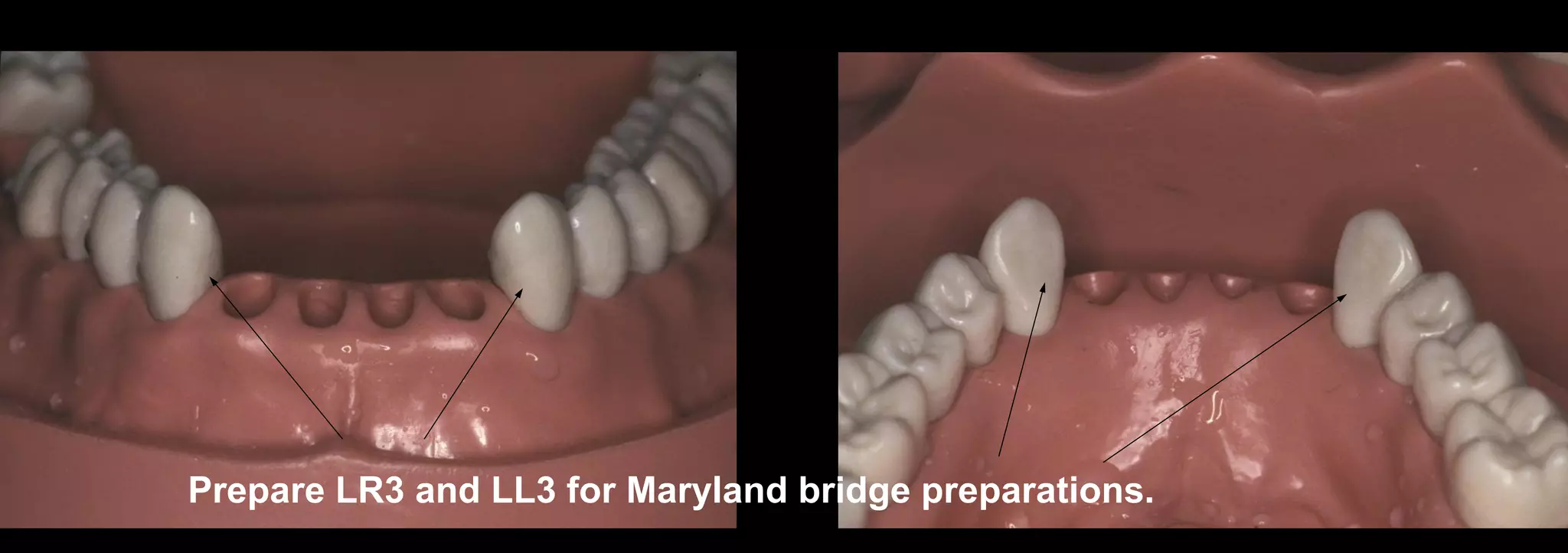 Tooth Preparation - Maryland preps | PDF