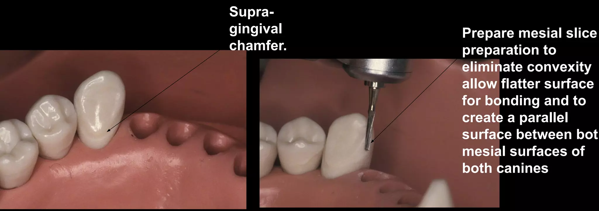 Tooth Preparation - Maryland preps | PDF