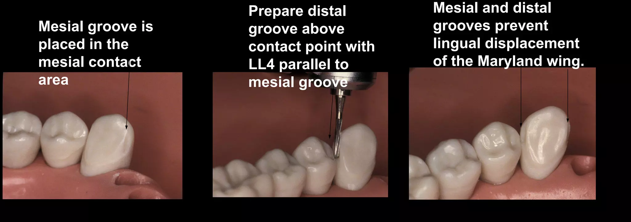 Tooth Preparation - Maryland preps | PDF