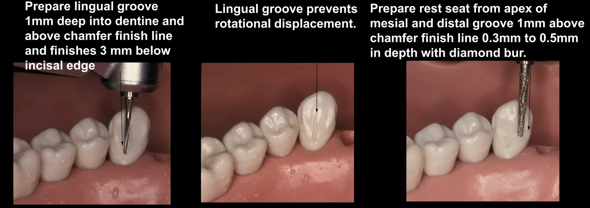 Tooth Preparation - Maryland preps | PDF