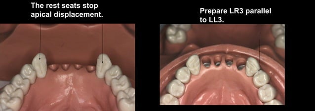 Tooth Preparation - Maryland preps | PDF