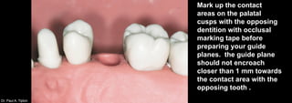Tooth Preparation - Maryland preps | PDF