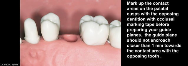 Tooth Preparation - Maryland preps | PDF