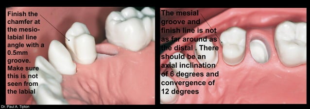 Tooth Preparation - Maryland preps | PDF