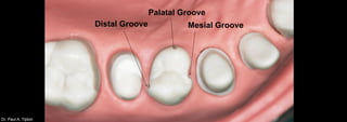Tooth Preparation - Maryland preps | PDF
