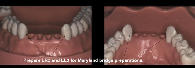 Tooth Preparation - Maryland preps | PDF