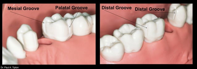 Tooth Preparation - Maryland preps | PDF