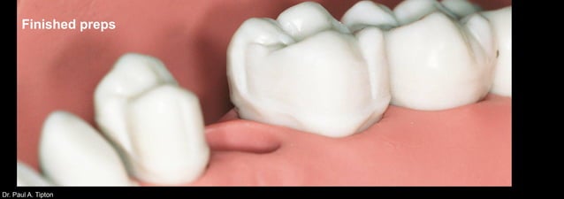 Tooth Preparation - Maryland preps | PDF