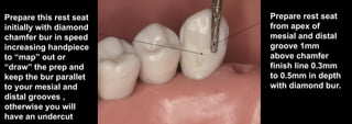 Tooth Preparation - Maryland preps | PDF