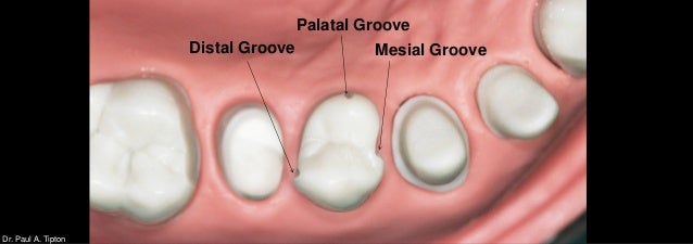Tooth Preparation - Maryland preps