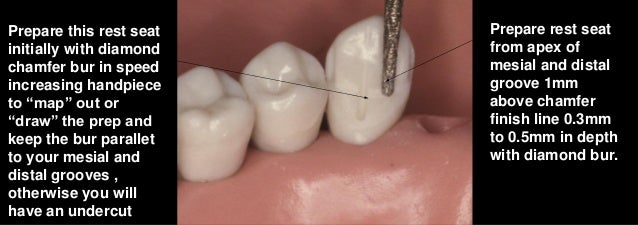 Tooth Preparation - Maryland preps