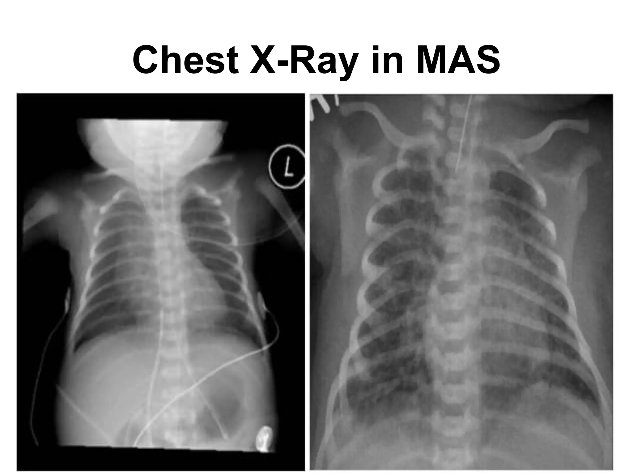Meconium Aspiration Syndrome | PPTX
