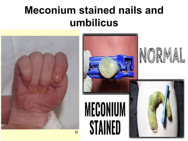 Meconium Aspiration Syndrome | PPTX