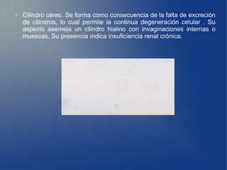 Cilindros en el sedimento urinario | ODP
