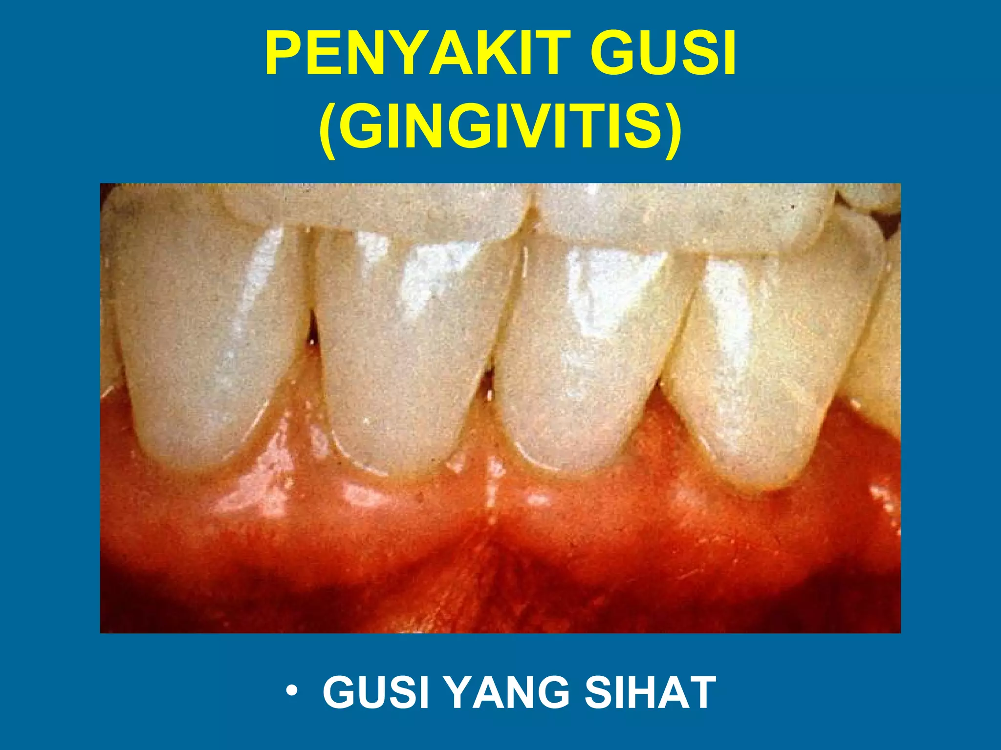 Masalah & Penyakit Pergigian | PPT