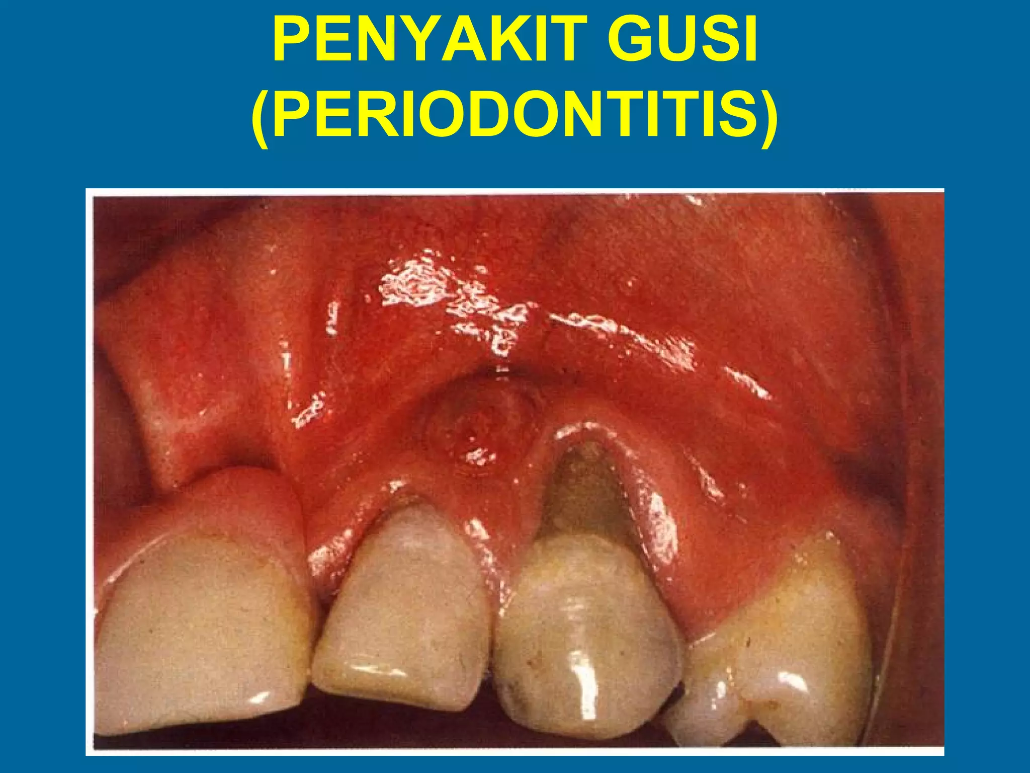 Masalah & Penyakit Pergigian | PPT
