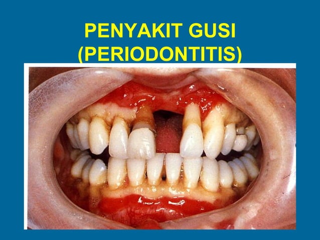 Masalah & Penyakit Pergigian | PPT