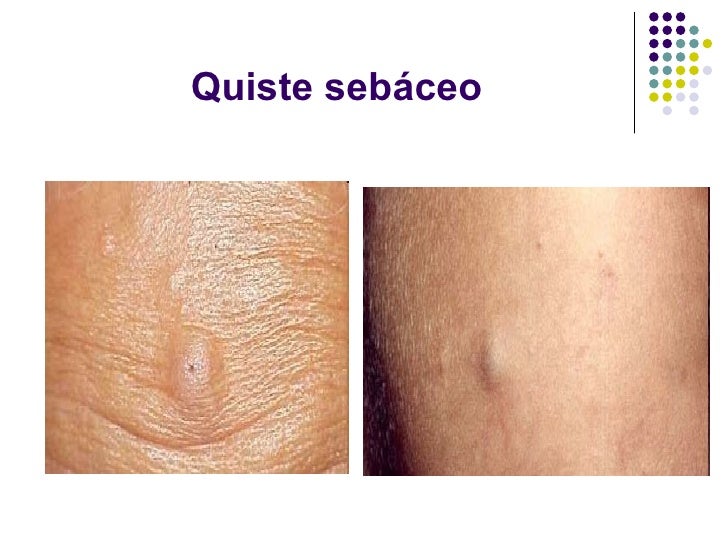 Masas En El Cuello. A Proposito De Un Caso.