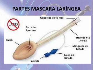 Mascarilla laríngea | PPTX