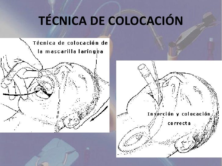 Mascarilla laríngea