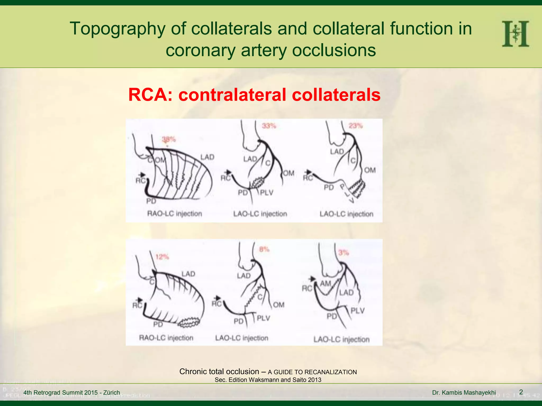 Mashayekhi Kambis - Ipsilateral retrograde approach in chronic total ...