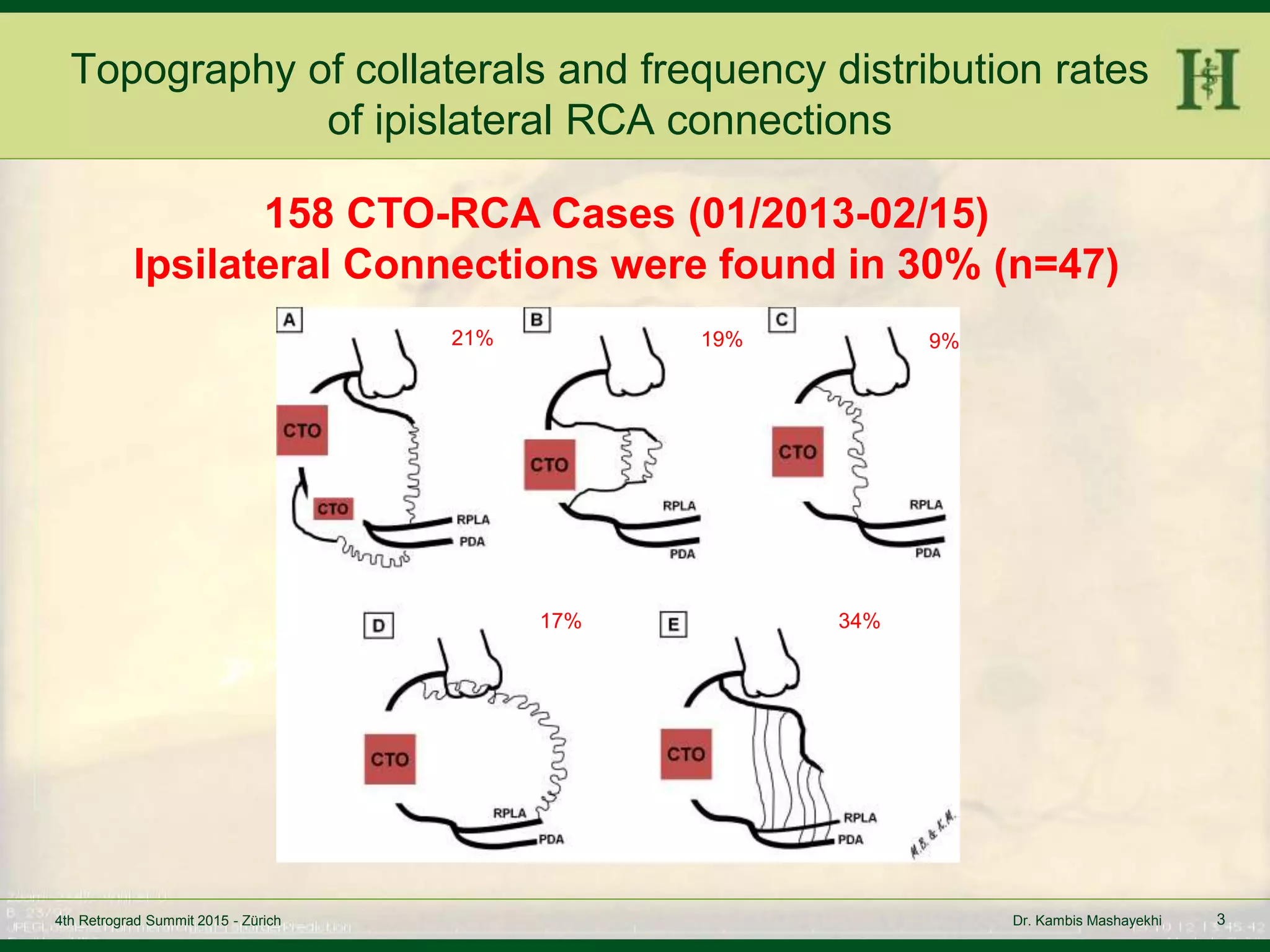 Mashayekhi Kambis - Ipsilateral retrograde approach in chronic total ...