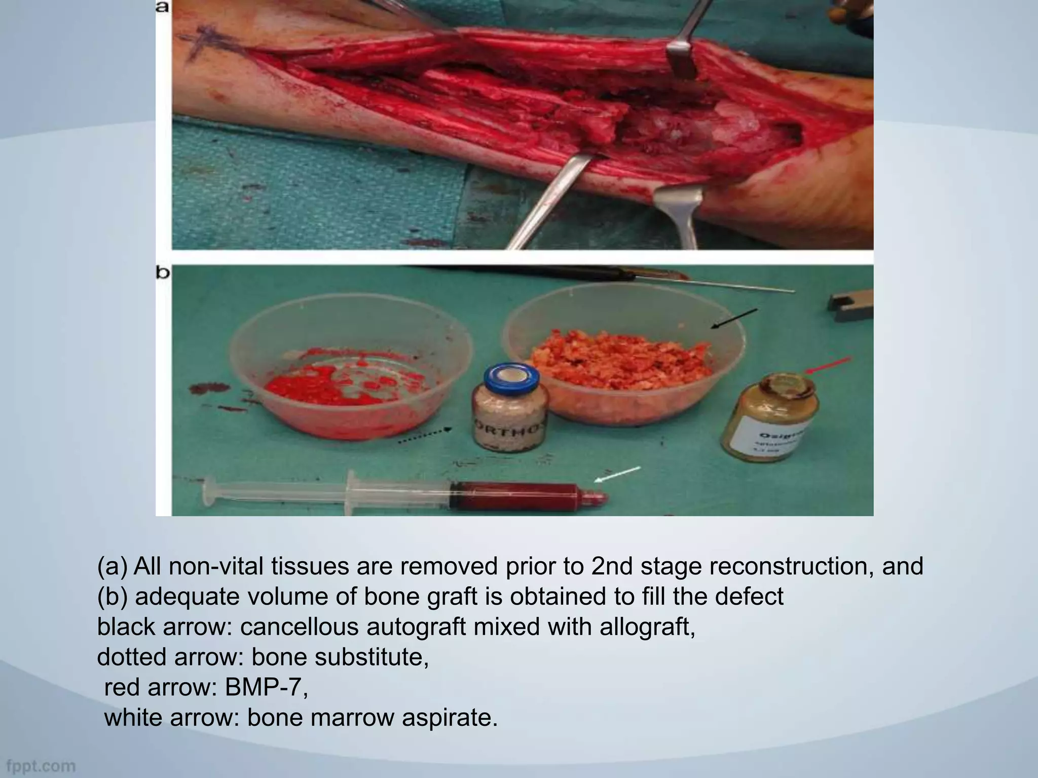 Masquelet technique for management of large bone defects. | PPTX
